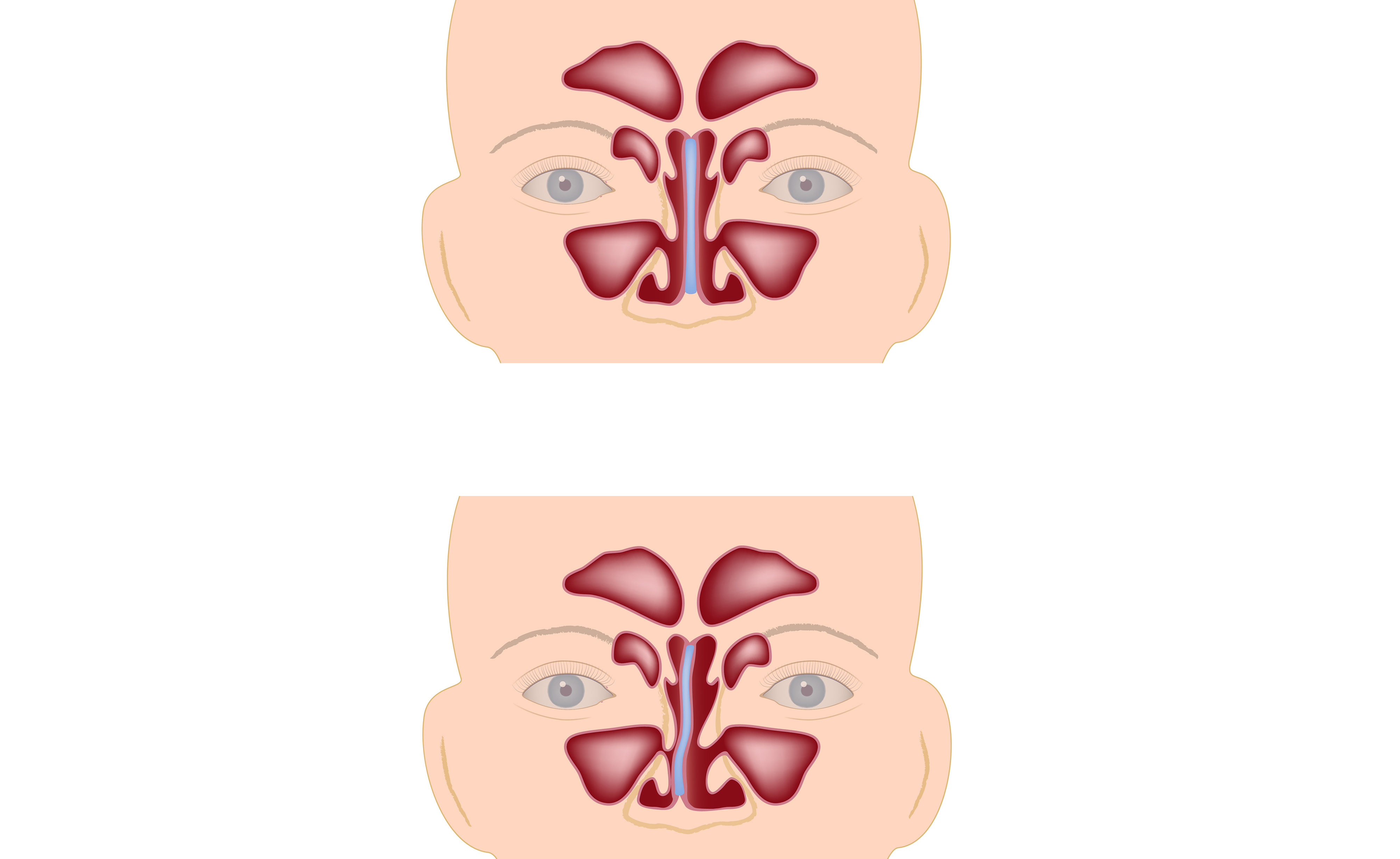 Apnee notturne: quando la causa è il setto nasale deviato | Pazienti.it