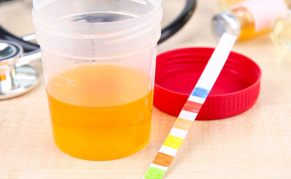 Il colore delle urine può rivelare uno stato di salute? | Pazienti.it