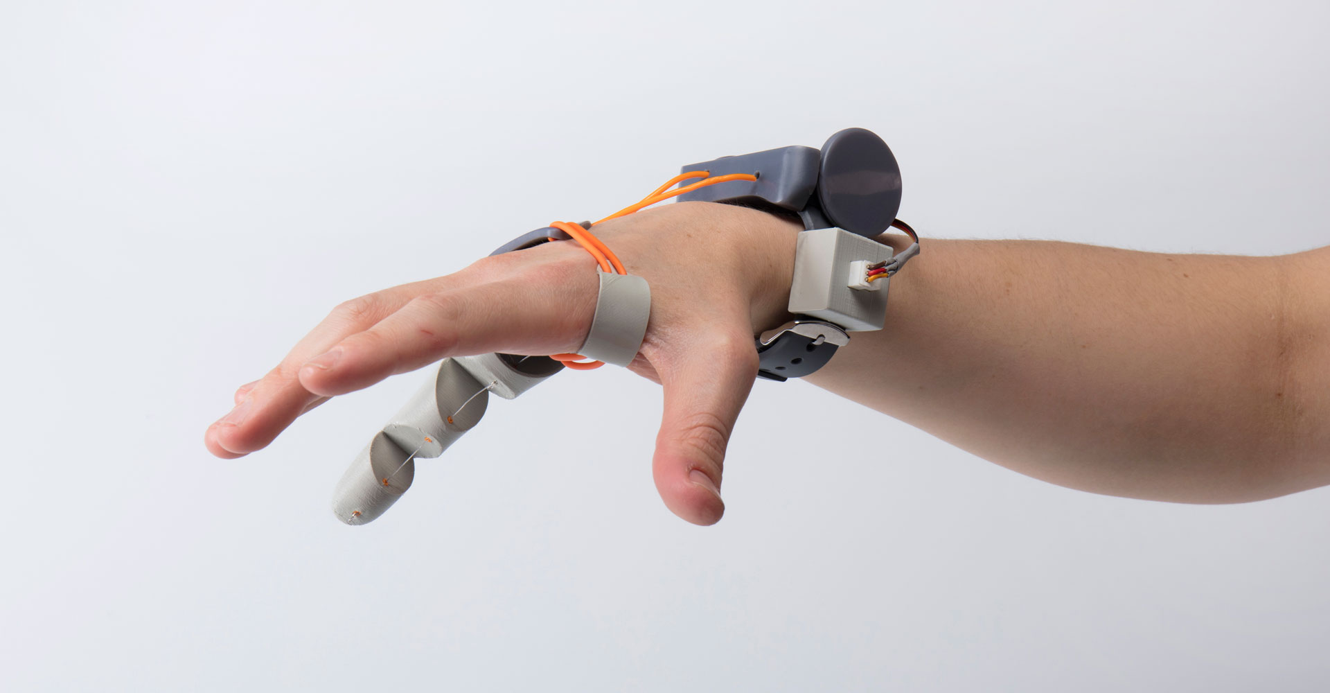 Smarte Daumenprothese: Sechs Finger bilden eine Faust